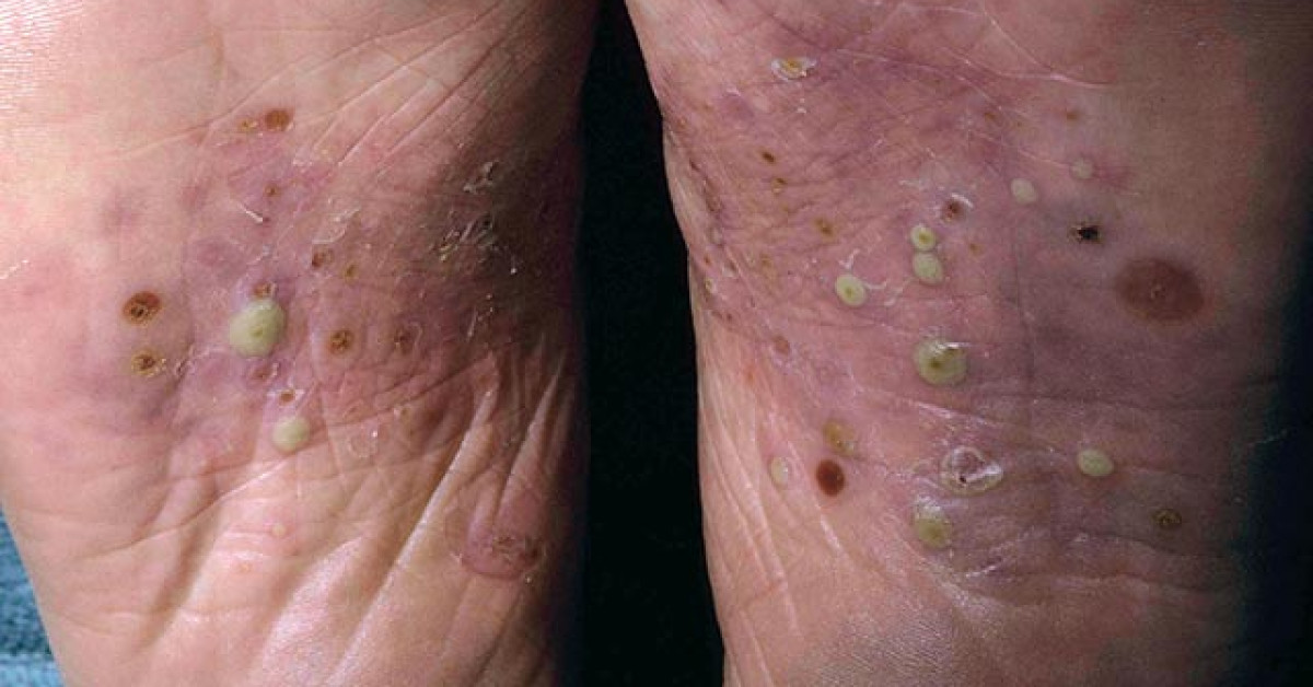 Palmoplantar pustulosis image