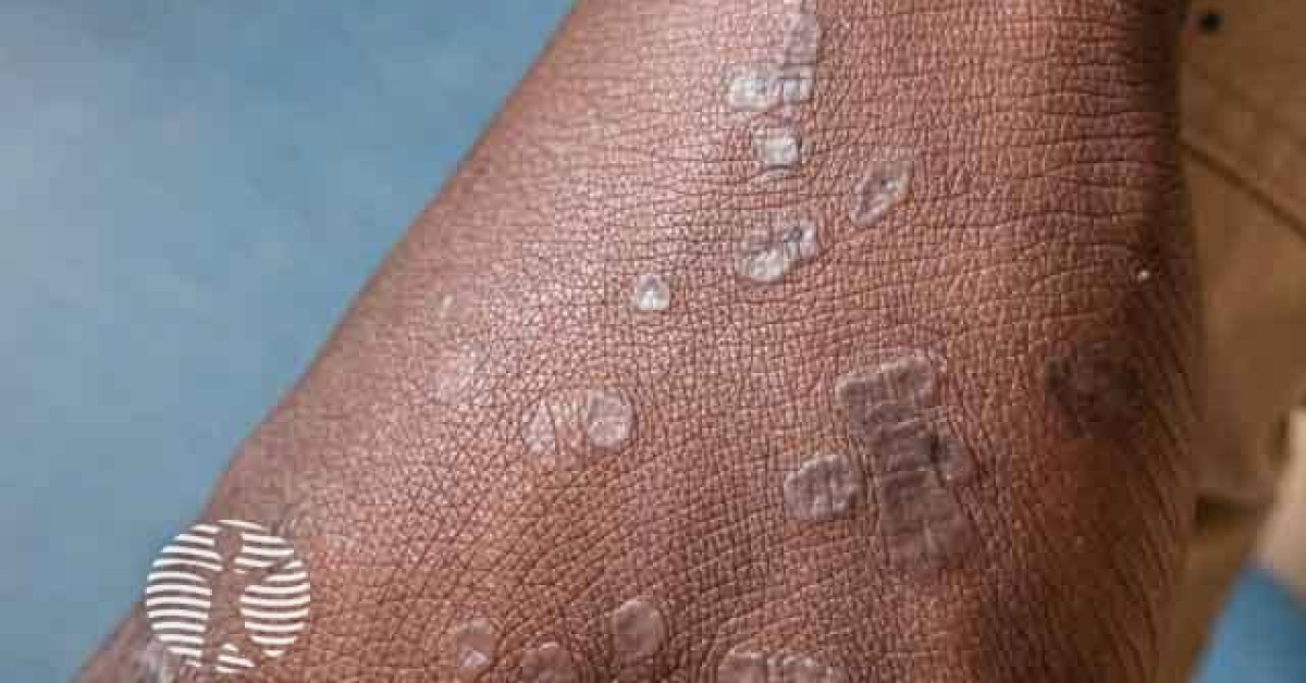 Papular lichen planus image