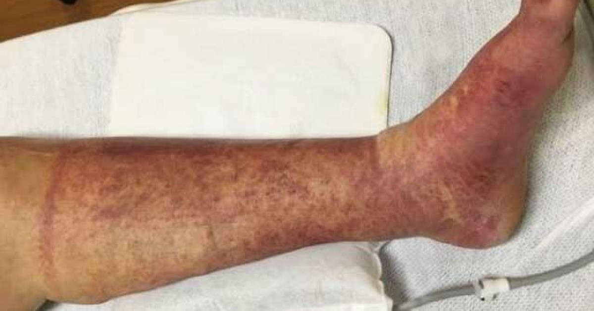 Papular purpuric gloves and socks syndrome image