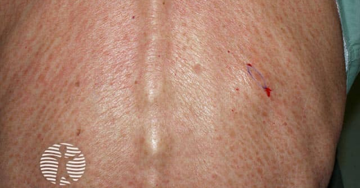 Papuloerythroderma of Ofuji image