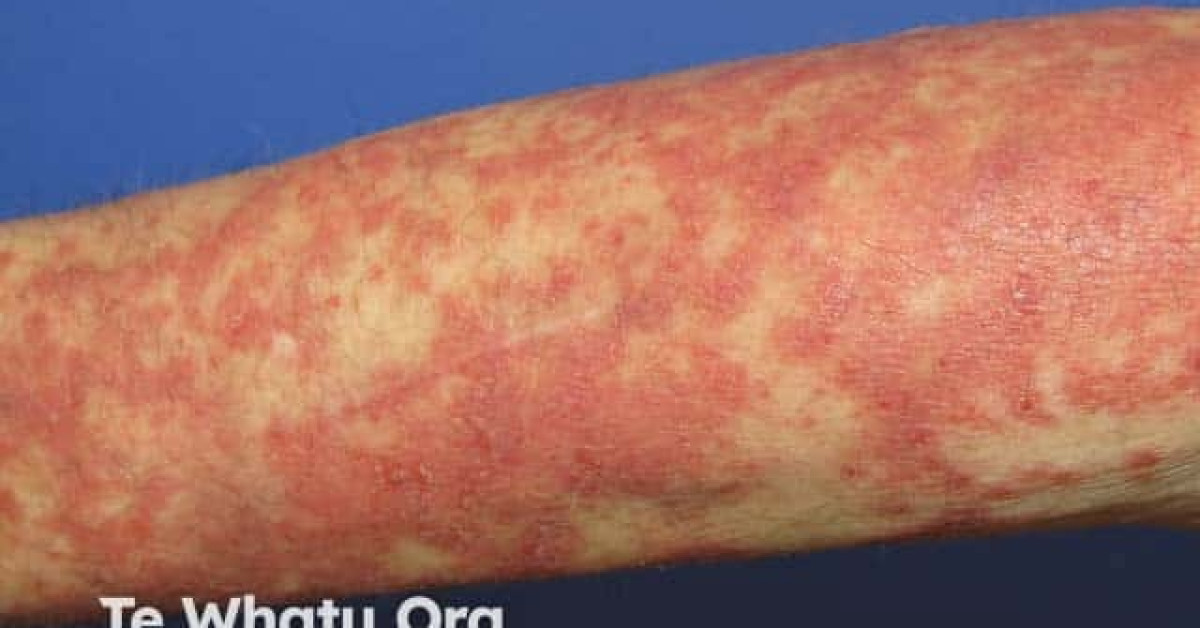 Paraneoplastic pemphigus image