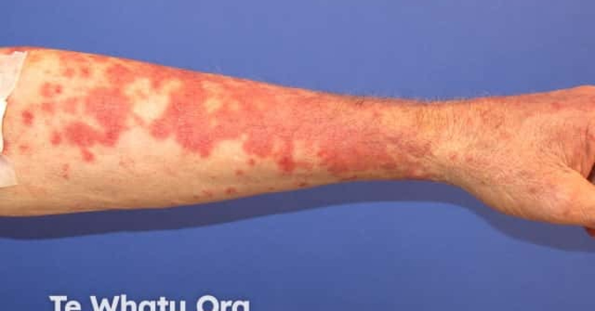 Paraneoplastic pemphigus image