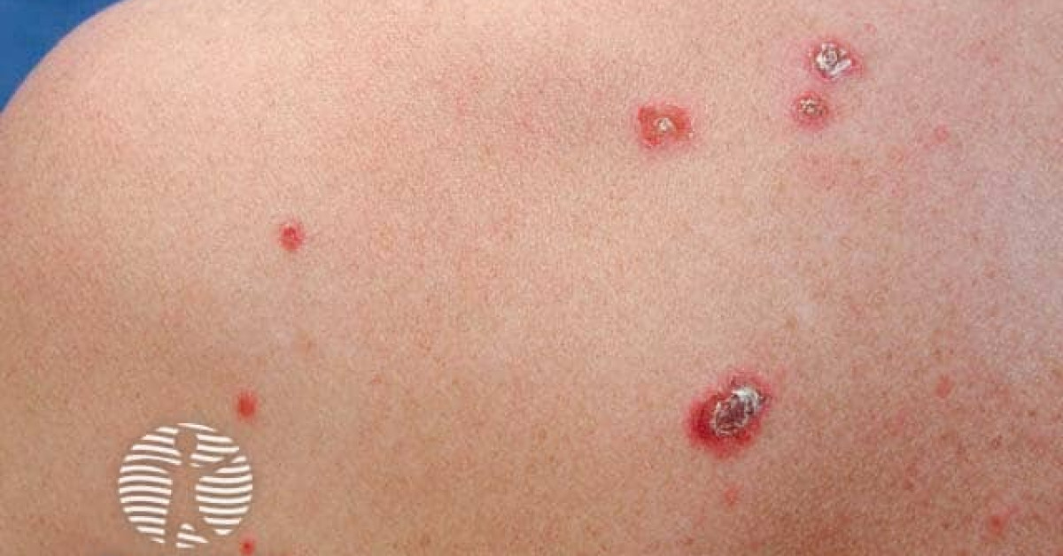 Paraneoplastic pemphigus image