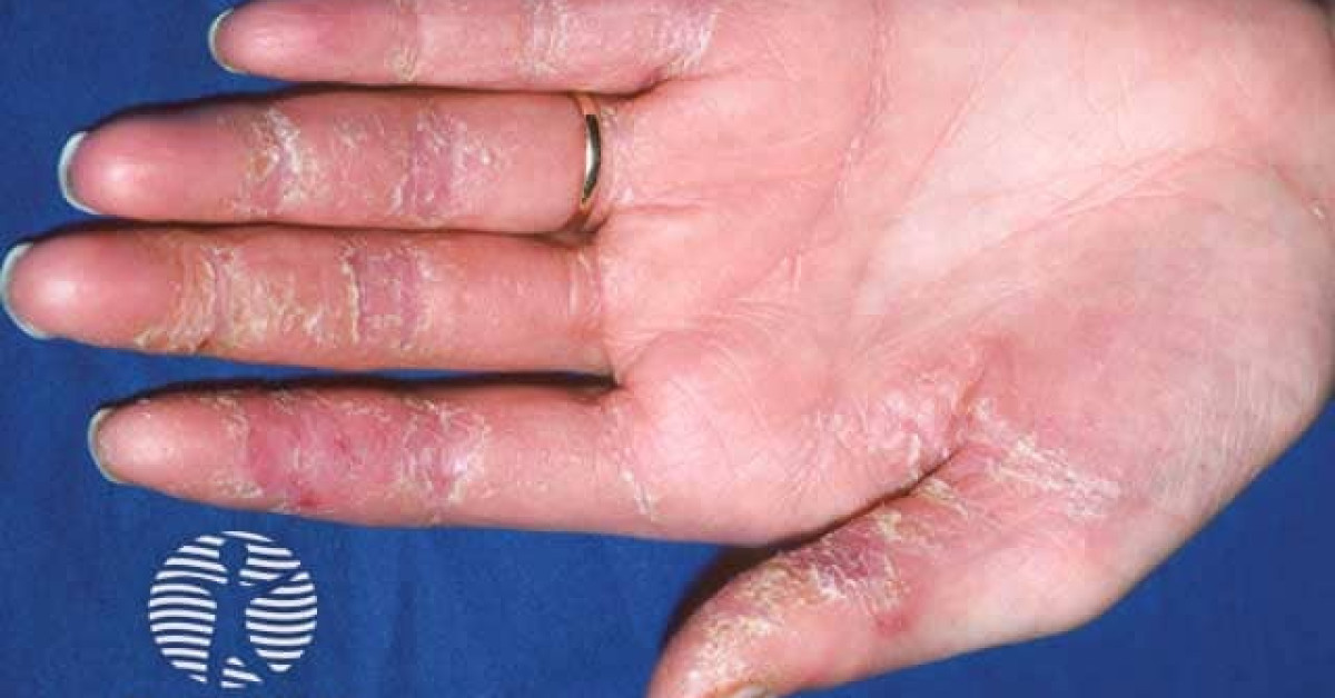 Paraneoplastic pemphigus image