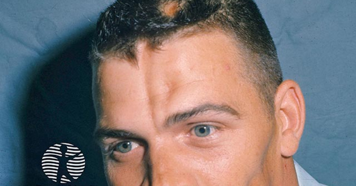 Parry-Romberg syndrome image