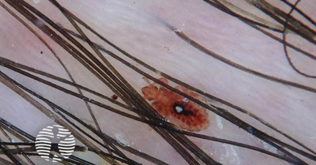 Pediculosis image