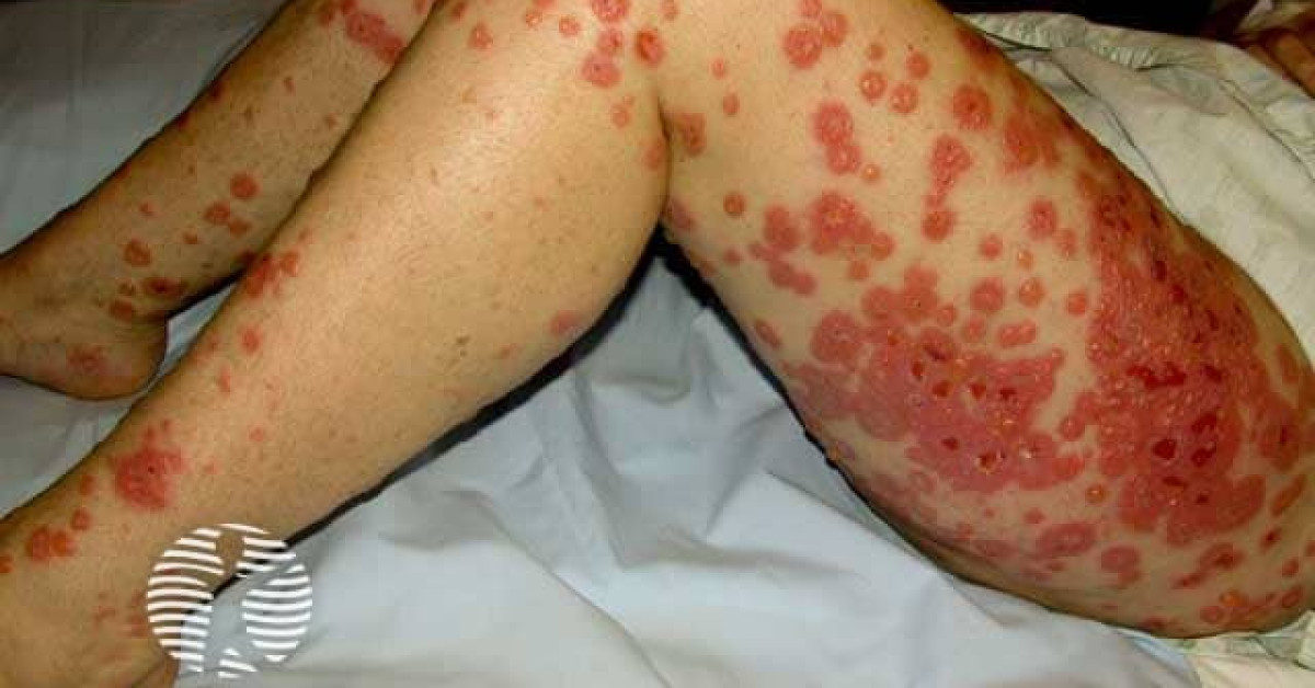 pemphigoid gestationis 00002 image