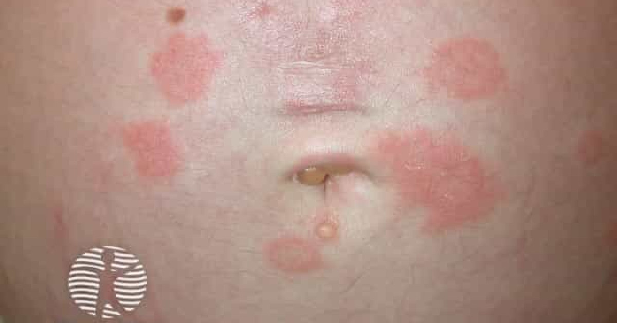 pemphigoid gestationis 00003 image