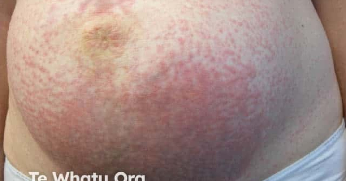 pemphigoid gestationis 00018 image