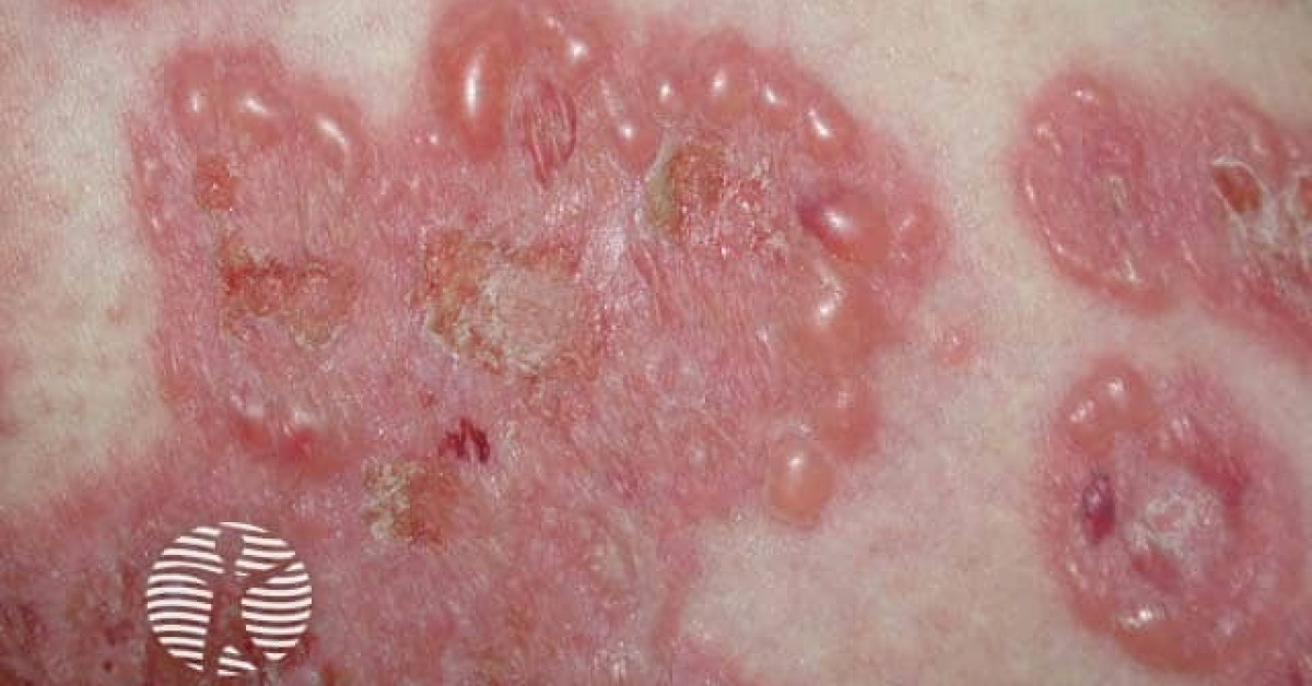pemphigoid gestationis 00026 image