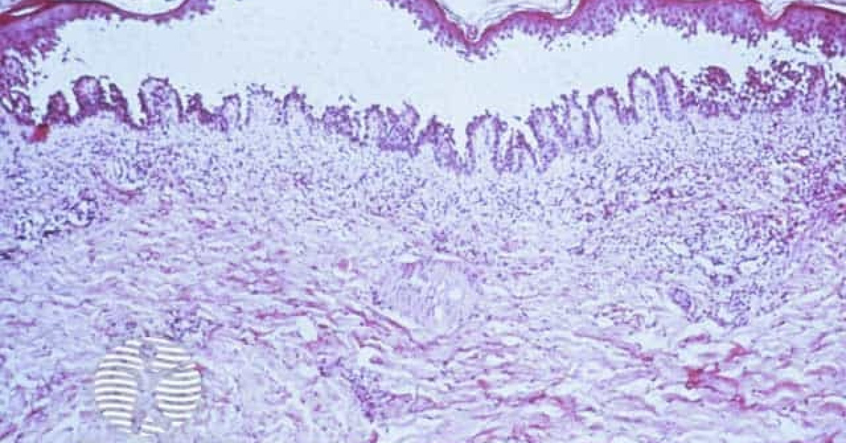 Pemphigus vulgaris image