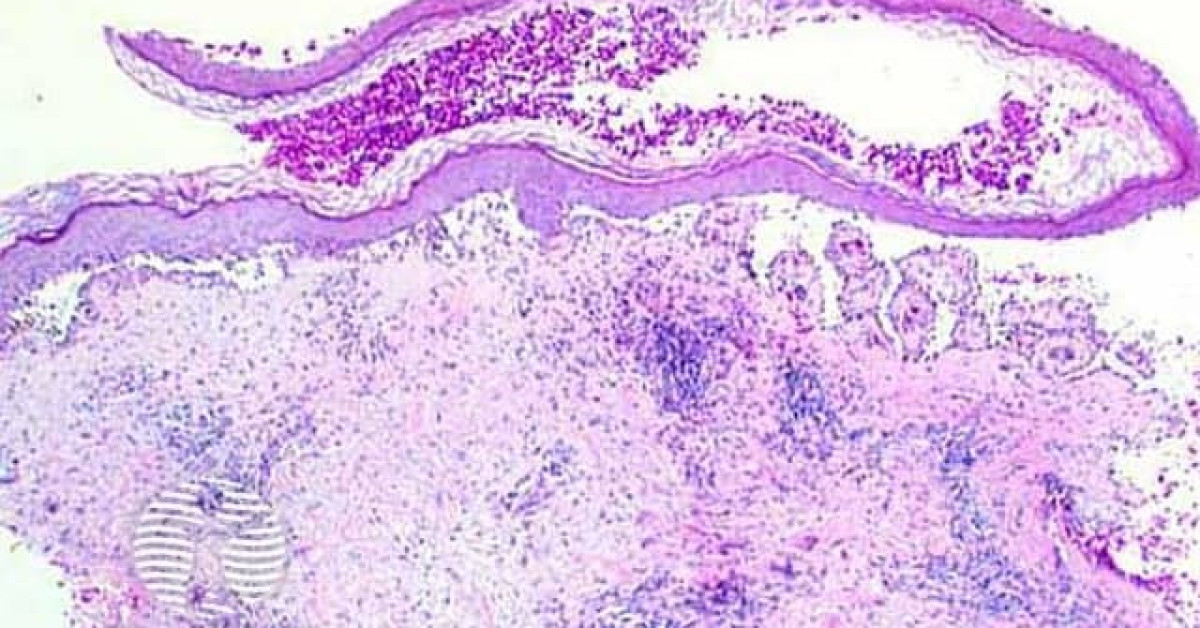 Pemphigus vulgaris image