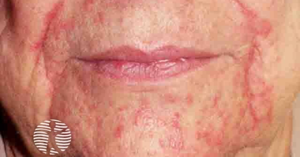 Perioral dermatitis image