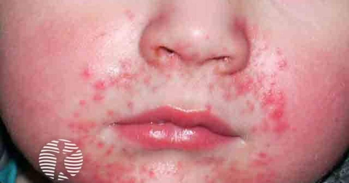 Perioral dermatitis image