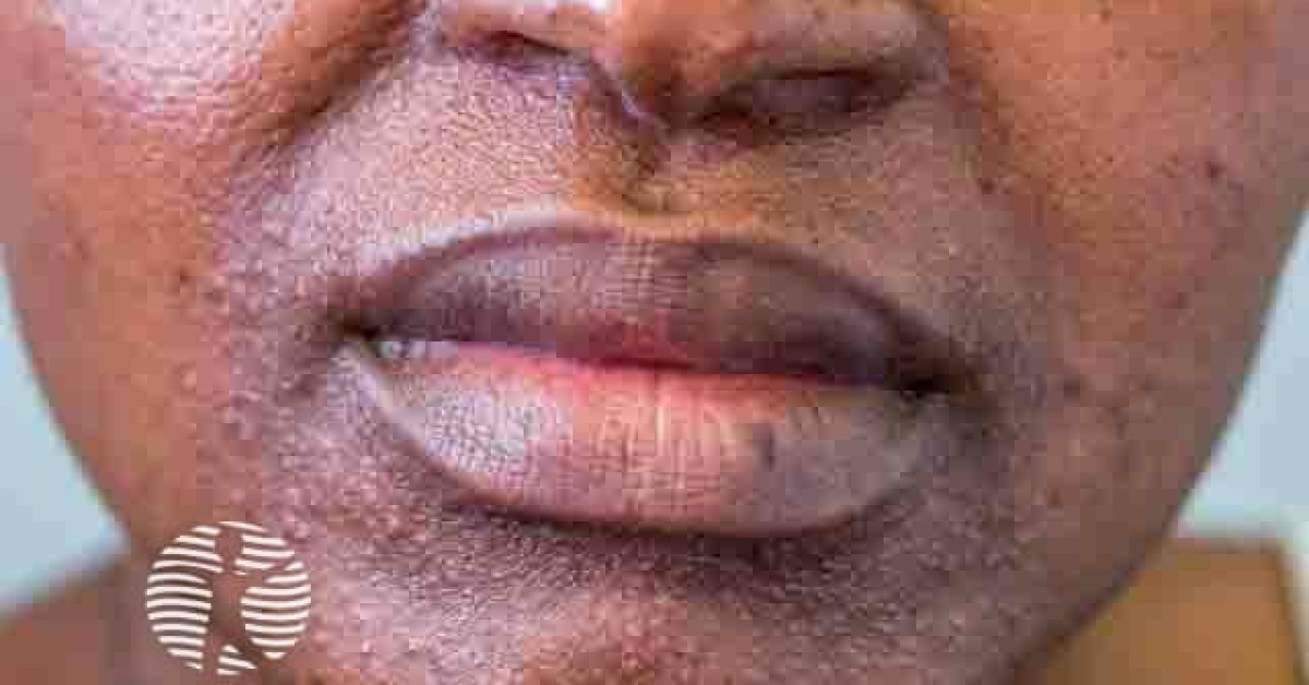 Perioral dermatitis image