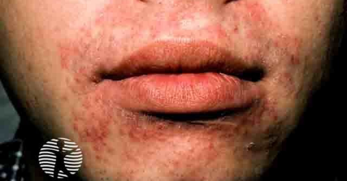 Periorbital Dermatitis Dermnet