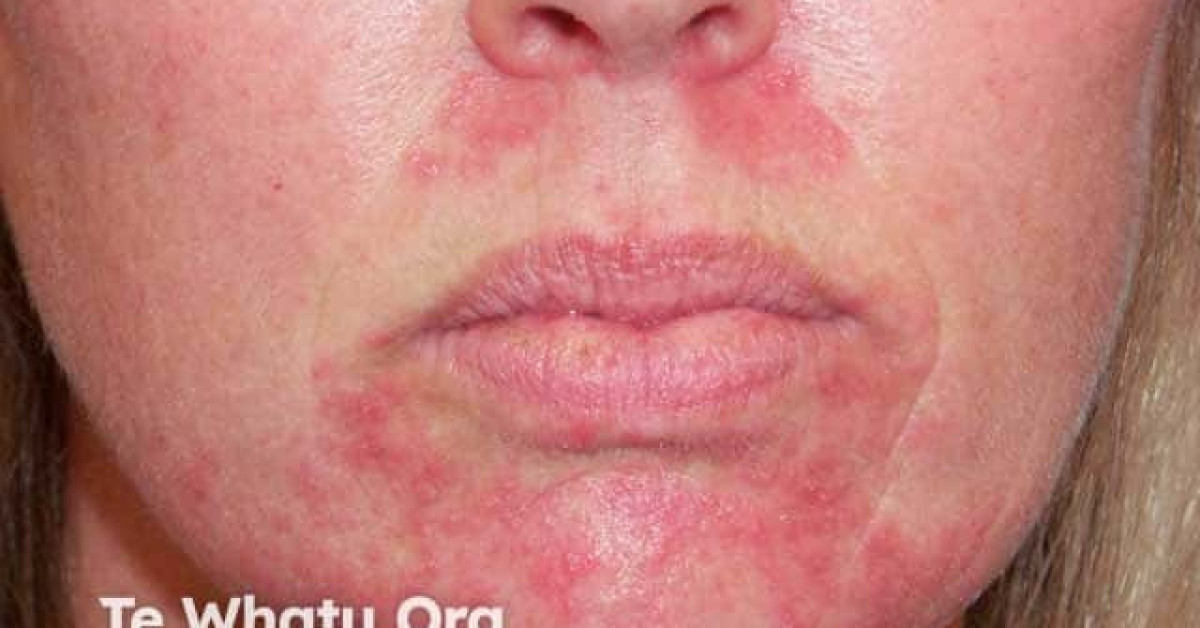 Perioral dermatitis image