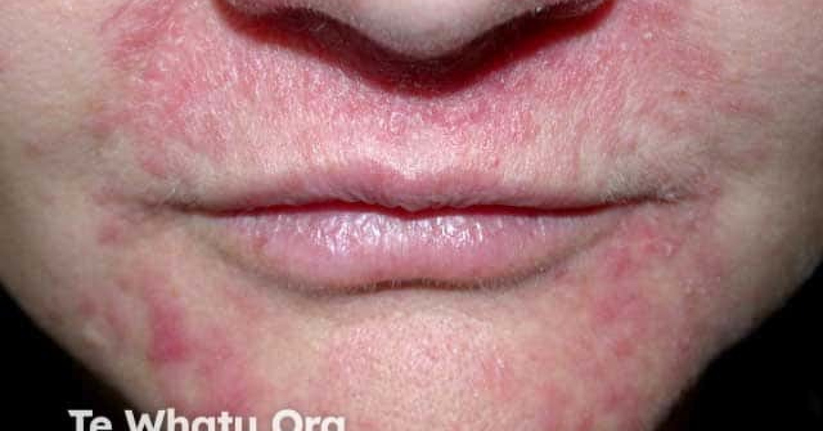 Perioral dermatitis image