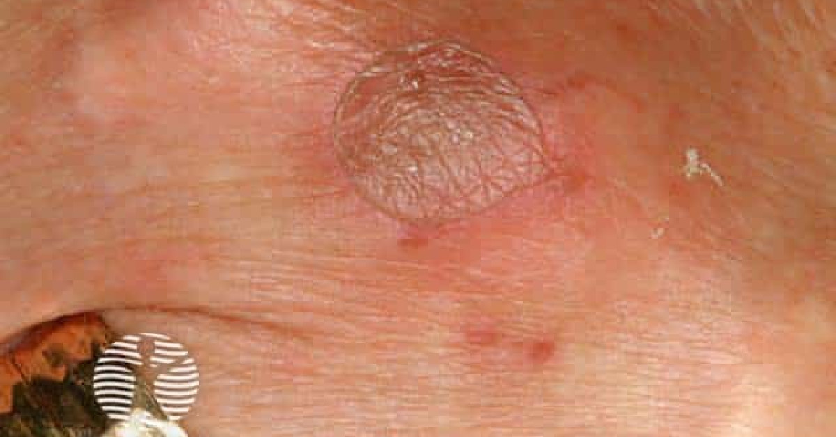 Phytophotodermatitis image