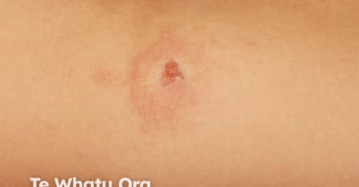 Phytophotodermatitis image