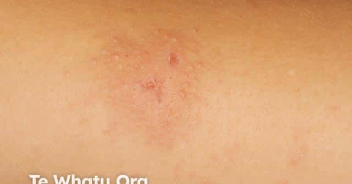 Phytophotodermatitis image