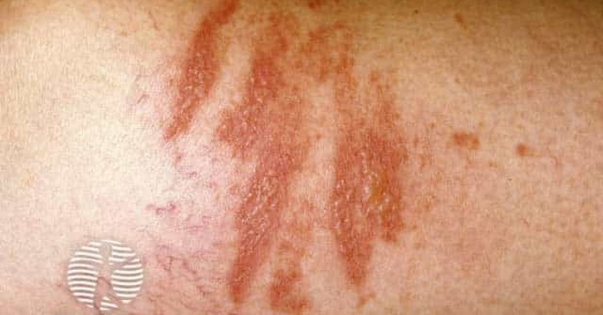 Phytophotodermatitis image