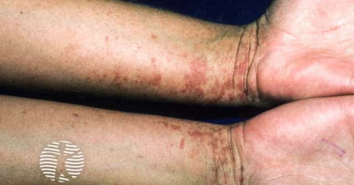 Phytophotodermatitis image