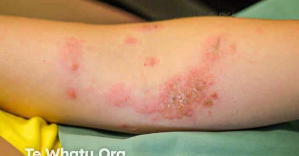 Phytophotodermatitis image