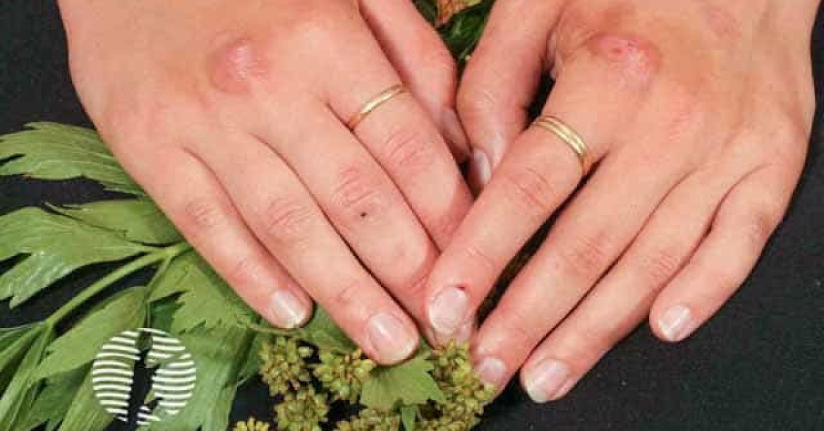 Phytophotodermatitis image