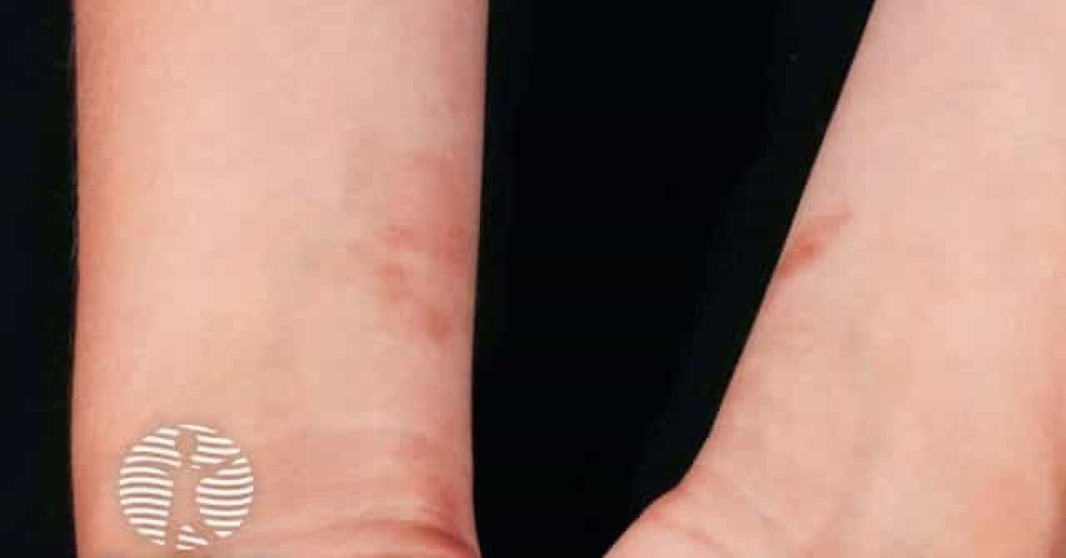 Phytophotodermatitis image