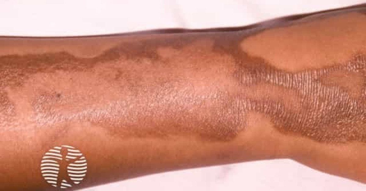 Phytophotodermatitis image