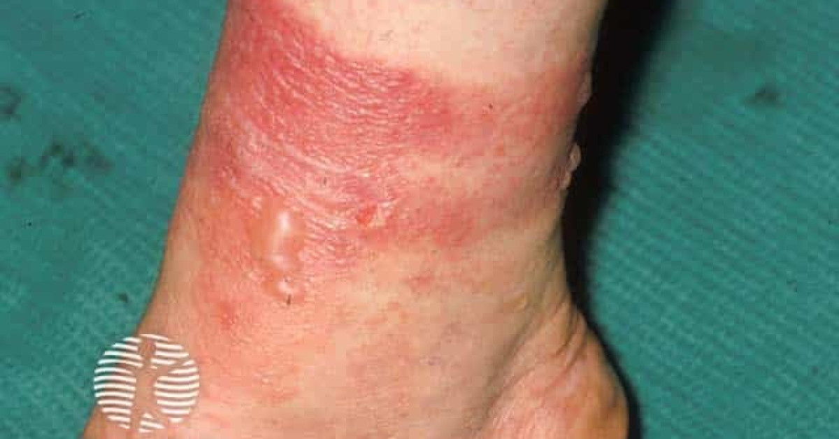 Phytophotodermatitis image