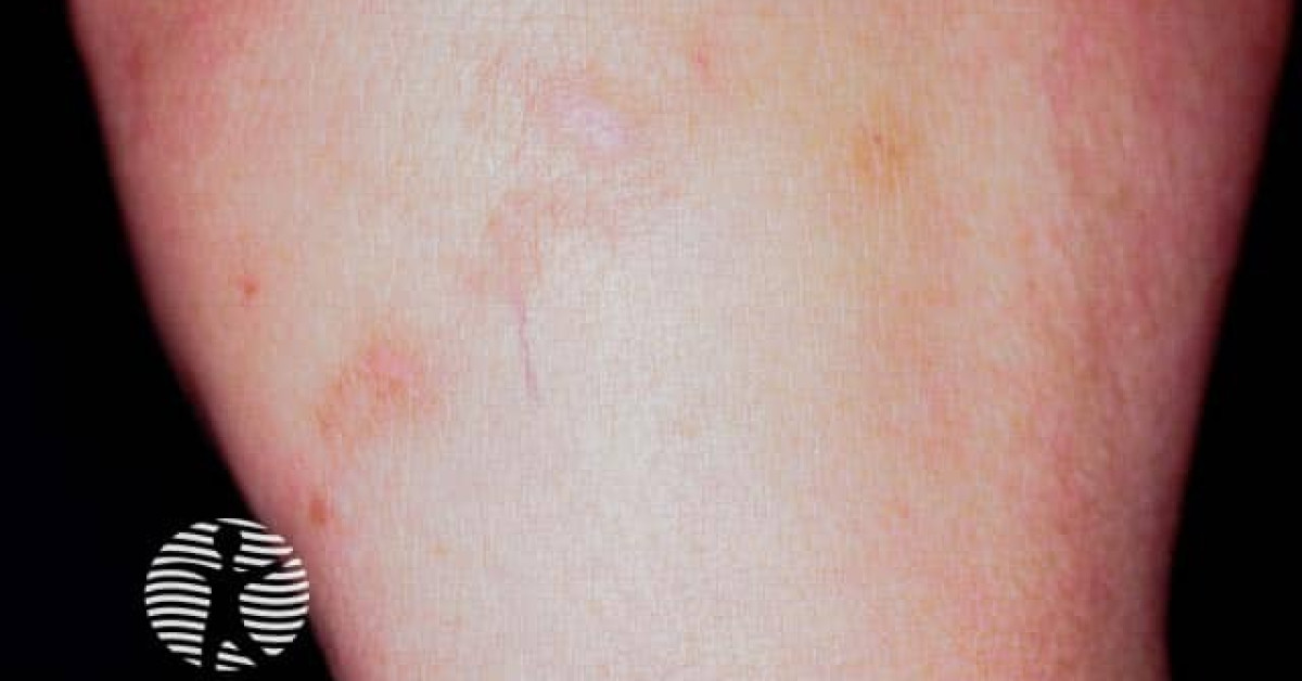 Phytophotodermatitis image