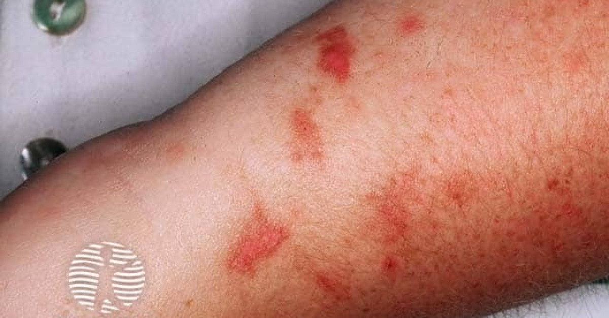 Phytophotodermatitis image