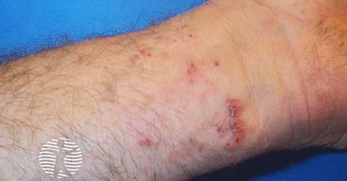 Phytophotodermatitis image