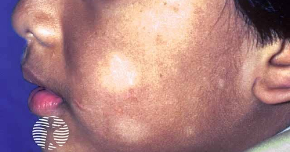 Pityriasis alba image