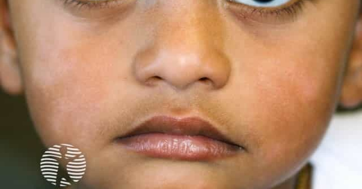 Pityriasis alba image