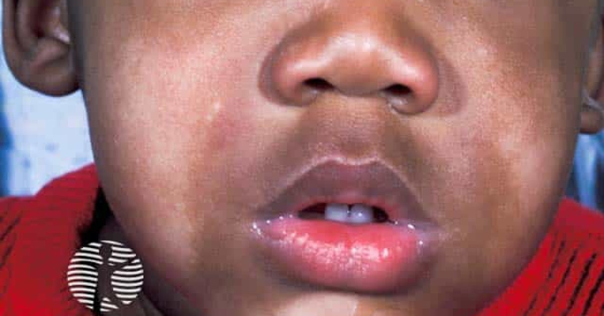 Pityriasis alba image