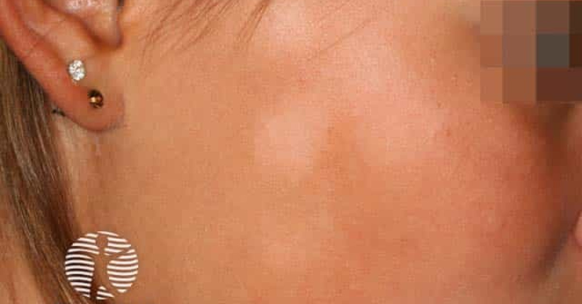 DermNet® - Pityriasis alba image