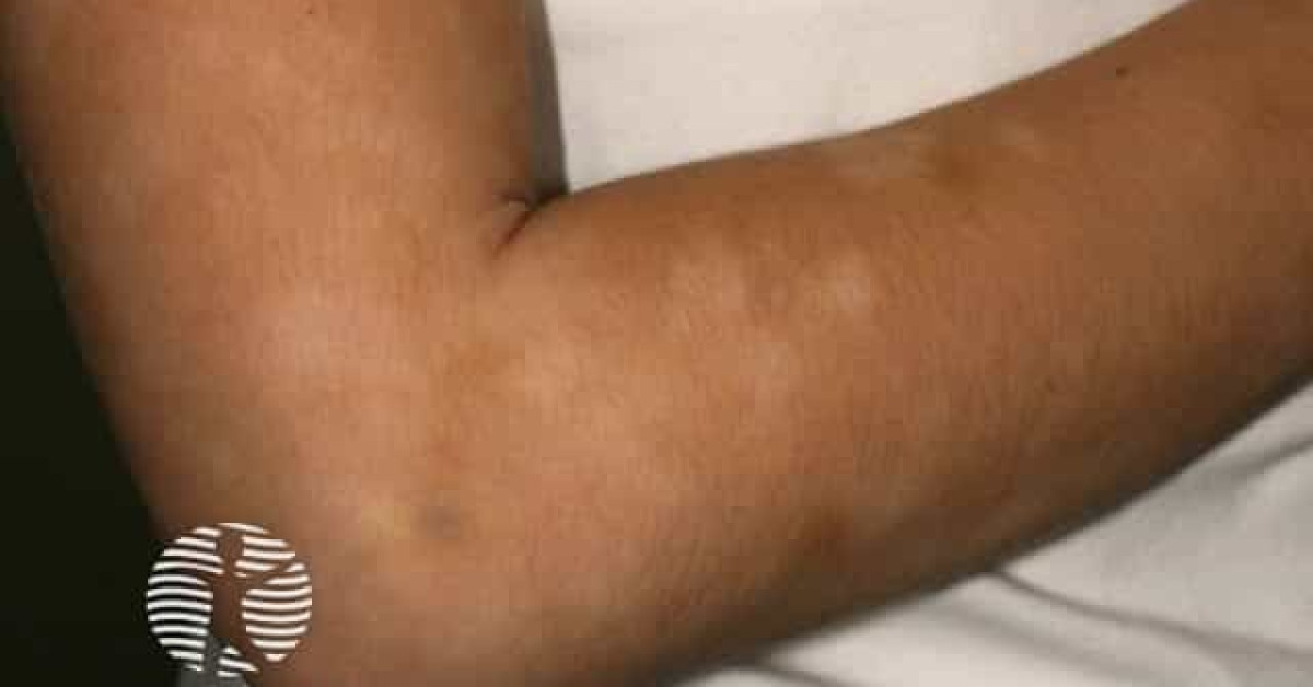 Pityriasis alba image
