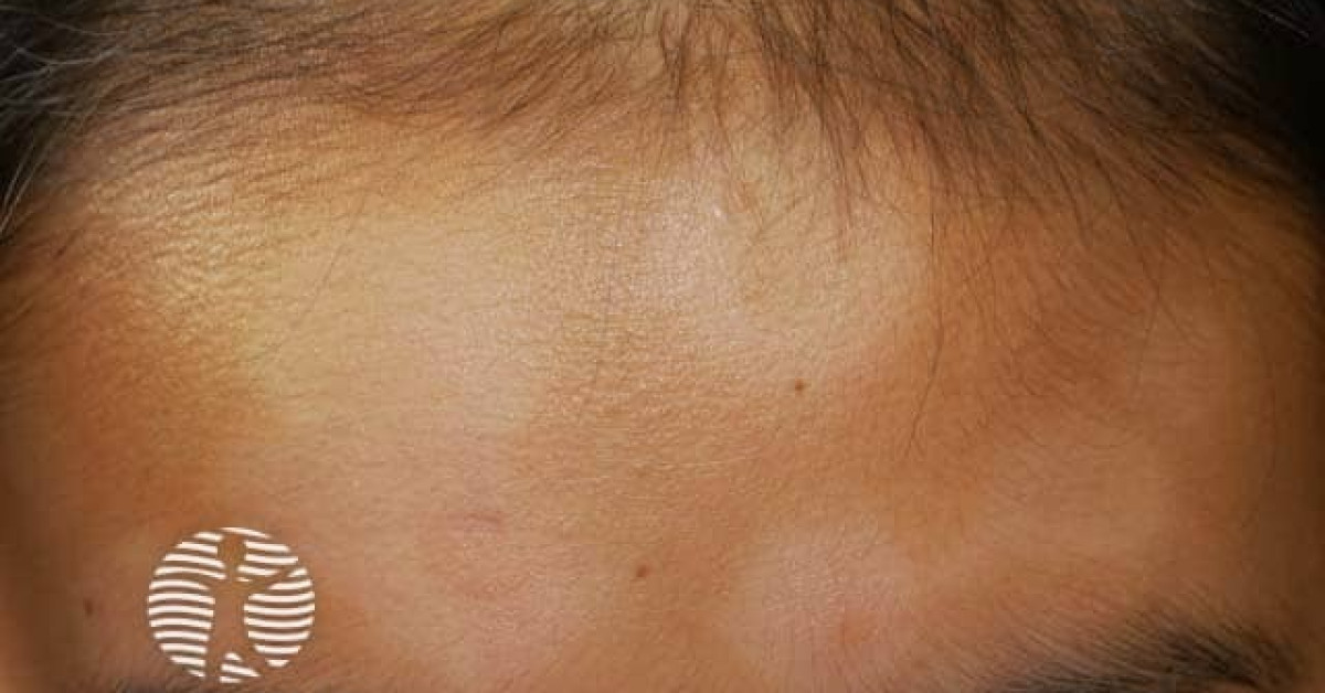 Pityriasis alba image