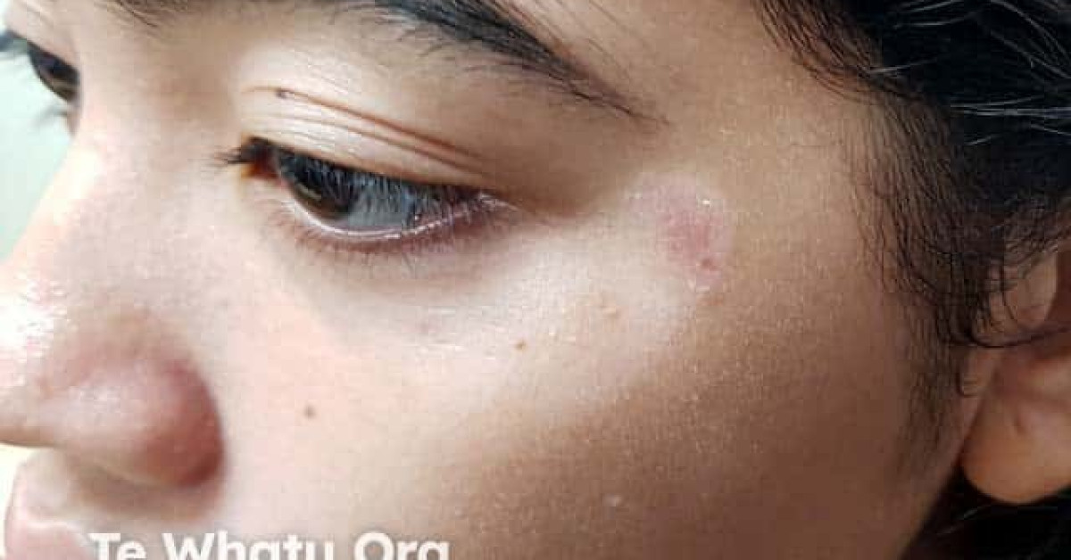 Pityriasis alba image