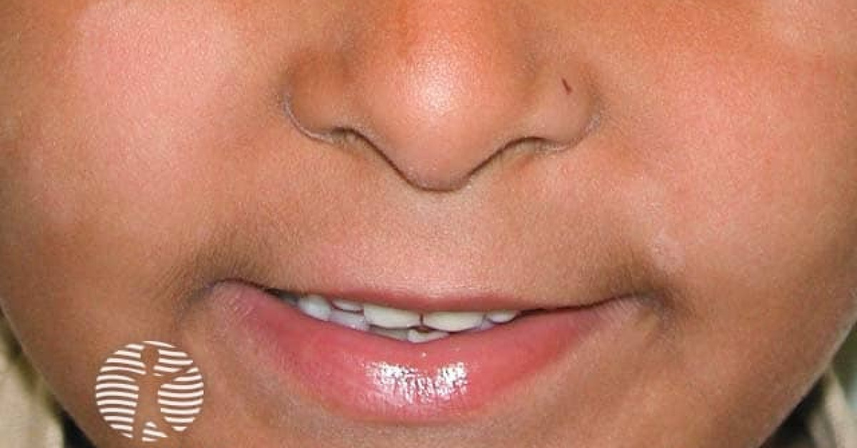 Pityriasis alba image