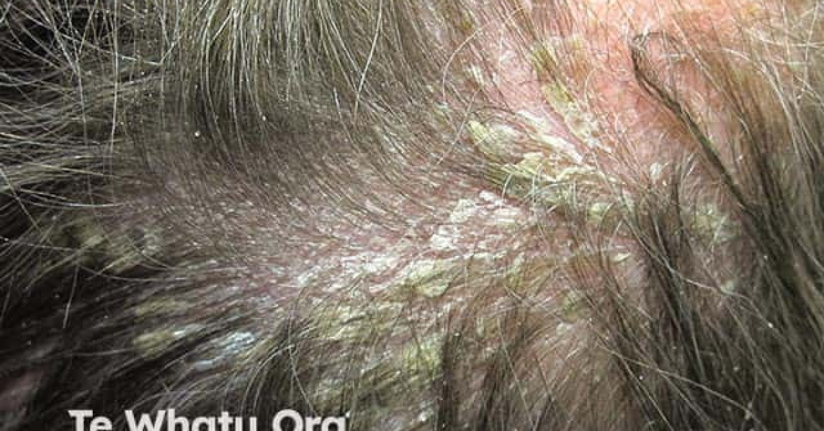 Pityriasis amiantacea image