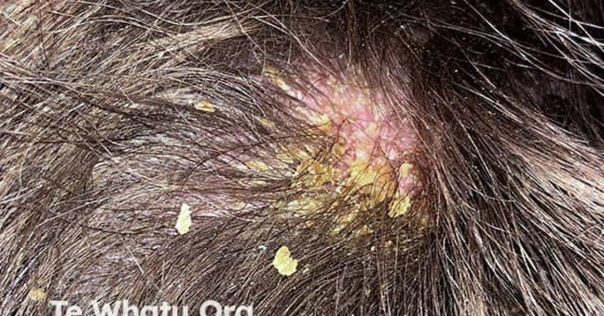 Pityriasis amiantacea image