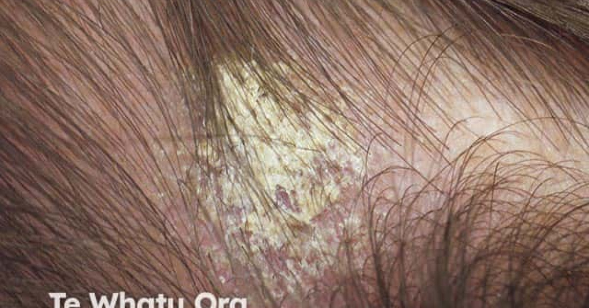 Pityriasis amiantacea image