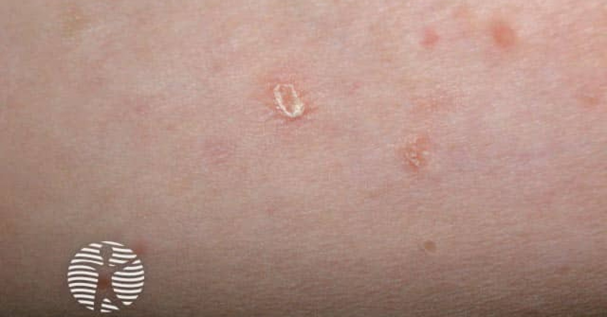 Pityriasis lichenoides image
