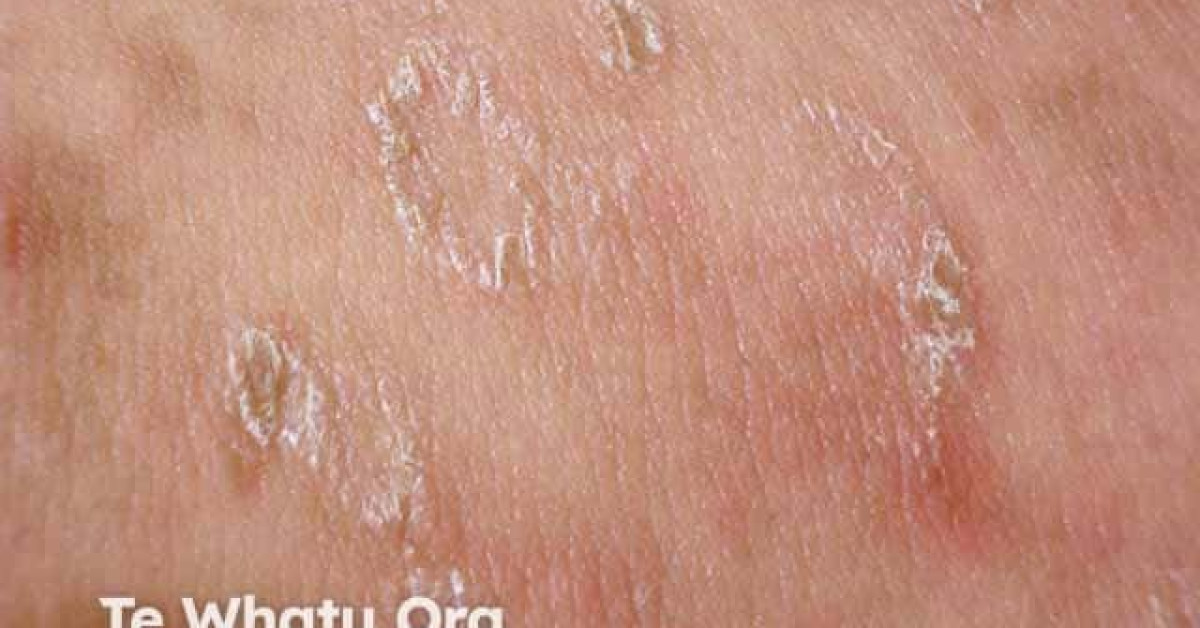 Pityriasis lichenoides image