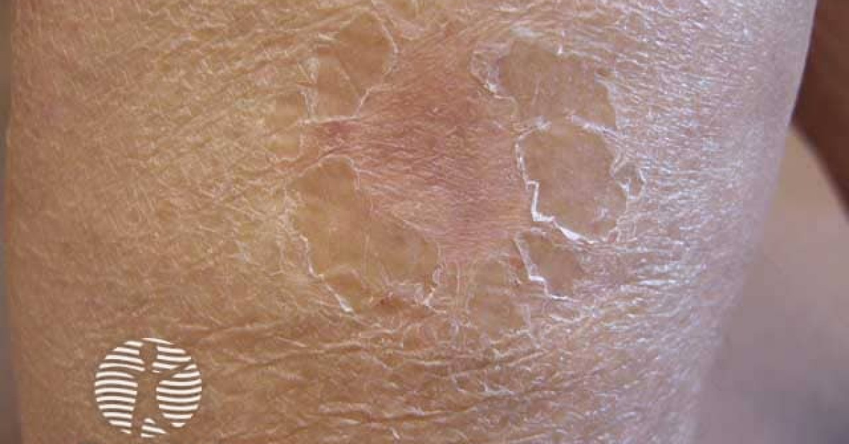 Pityriasis lichenoides image