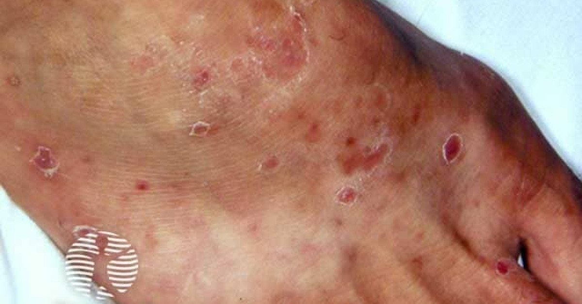 Pityriasis lichenoides image